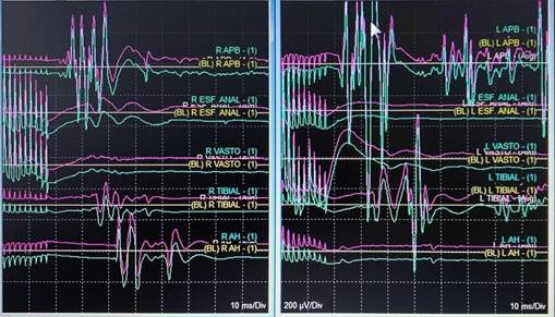 Monitoreo neurofisiológico intraoperatorio, lo que el anestesiólogo ...