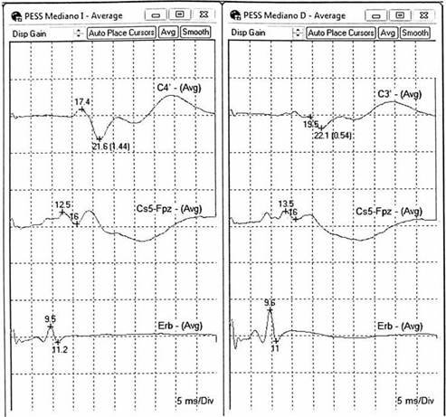 Monitoreo neurofisiológico intraoperatorio, lo que el anestesiólogo ...