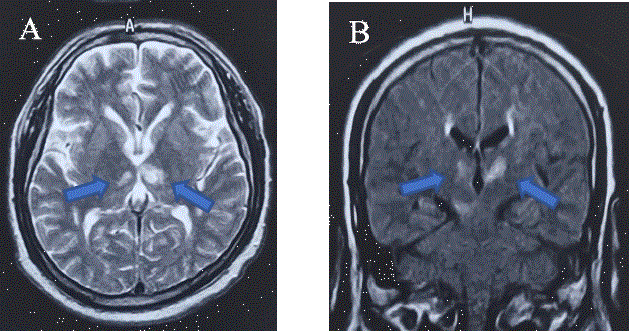 Percheron artery syndrome: case report and review literature
