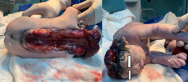 Craniorachischisis totalis: a rare neural malformation