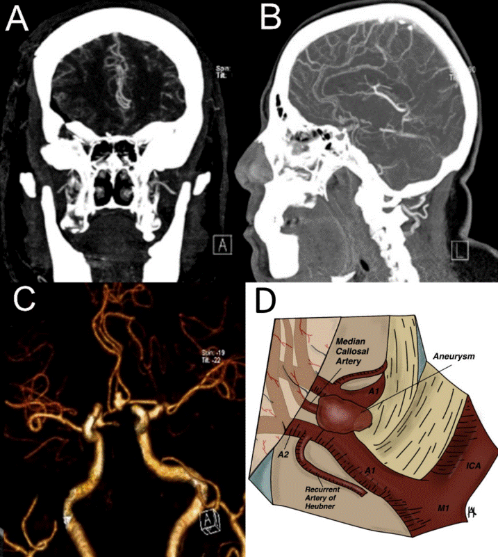Median artery of the corpus callosum in the context of AComA aneurysm ...