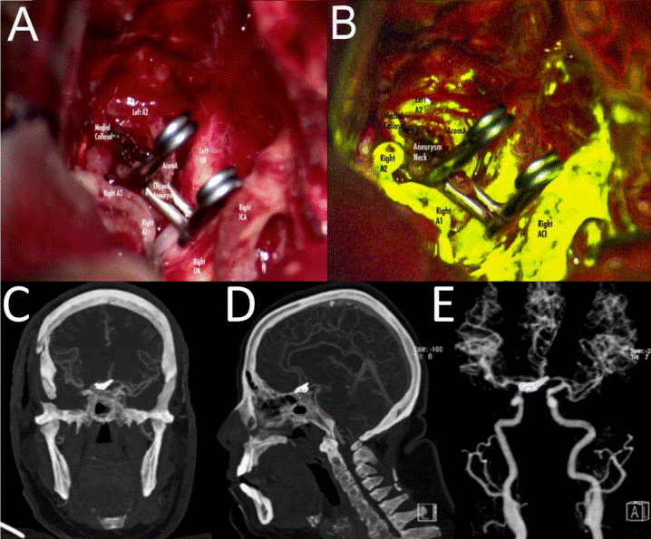 Median artery of the corpus callosum in the context of AComA aneurysm ...