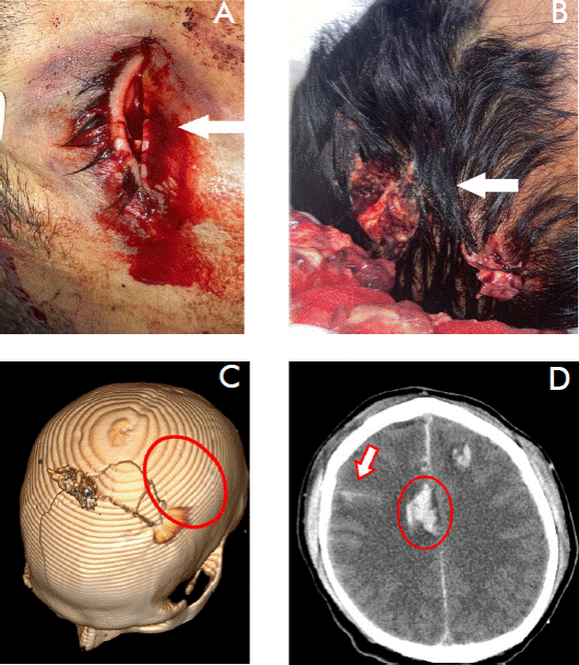 Bilateral decompressive craniectomy in a patient with head injuries ...