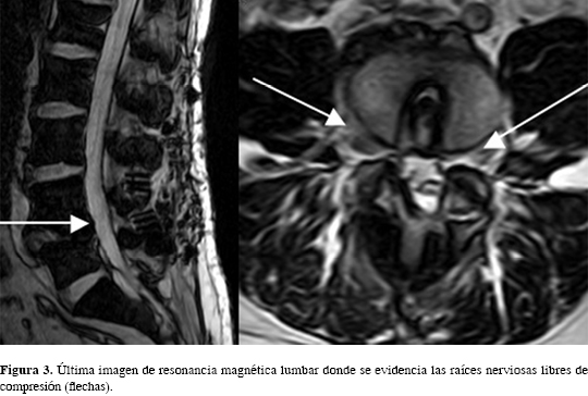 Síndrome de Forestier: Reporte de un caso y revisión de la literatura