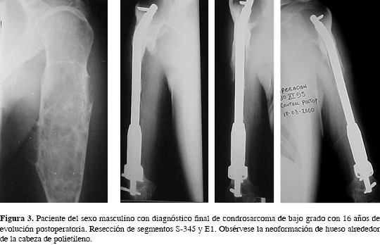 Tratamiento y reconstrucción en tumores óseos del húmero con prótesis ...