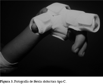 Apertura del primer espacio en pacientes con artrogriposis múltiple ...