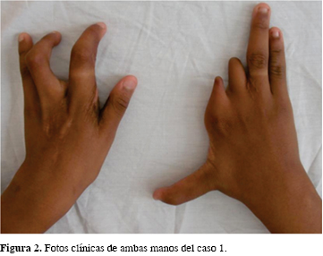 Ectrodactilia del pie. Reporte de dos casos