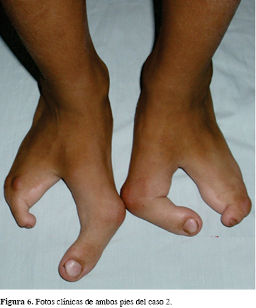 Ectrodactilia Em Caes Tratamiento Quirúrgico De La Ectrodactilia En