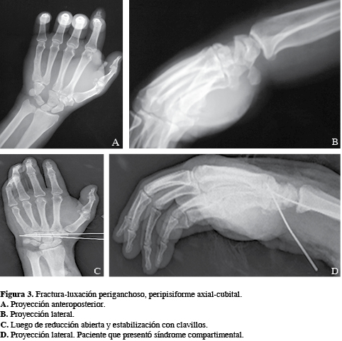 Fractura luxación axial del carpo. Reporte de tres casos y revisión de ...