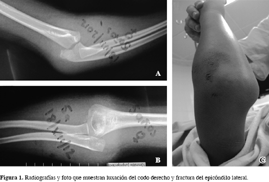 Luxación del codo y fractura del epicóndilo lateral en una niña de 5 ...