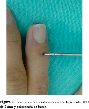 Resección de la superficie articular por abordaje dorsal mínimamente ...