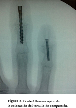 Resección de la superficie articular por abordaje dorsal mínimamente ...