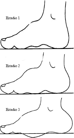 La neuroartropatía de Charcot en el pie diabético