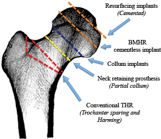 A proposal for the study of cementless short-stem hip prostheses