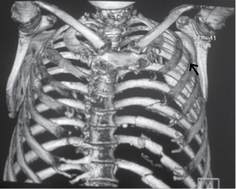 Fijación de tórax inestable con placas y tornillos bioabsorbibles ...