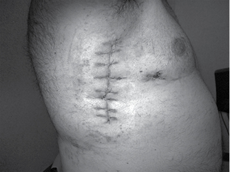 Fijación de tórax inestable con placas y tornillos bioabsorbibles ...