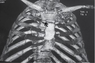 Fijación de tórax inestable con placas y tornillos bioabsorbibles ...