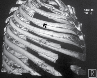 Fijación de tórax inestable con placas y tornillos bioabsorbibles ...
