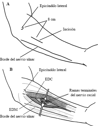 Una opción para restaurar la musculatura intrínseca cubital cuando el ...