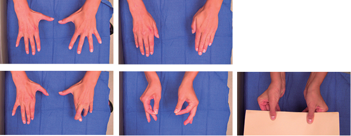 Nervio Cubital Mano En Garra