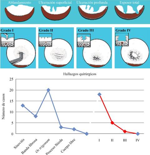 Tratamiento endoscópico del pinzamiento posterior del tobillo