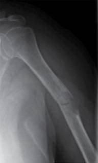 Continuous pain and swelling after humerus fracture in an 86-years-old ...