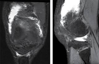 Sinovitis vellonodular pigmentada localizada, causa de hemartrosis en ...