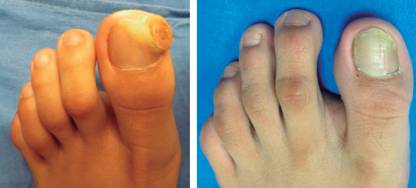 Osteocondromas: presentación del osteocondroma subungueal