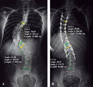 A new technique of pedicle screw placement with the use of sequential ...