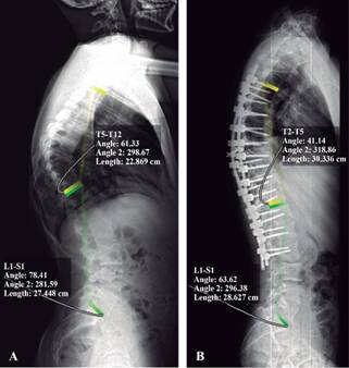 A new technique of pedicle screw placement with the use of sequential ...