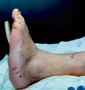 Treatment algorithm for Charcot foot and surgical technique with ...