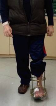 Treatment algorithm for Charcot foot and surgical technique with ...