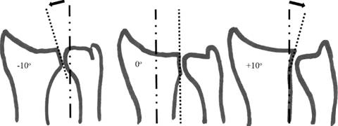 Ulnar shortening: results for treatment of distal radioulnar joint ...
