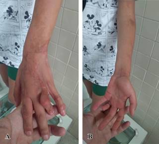 Manejo ortopédico de la esclerodermia lineal localizada en niños ...