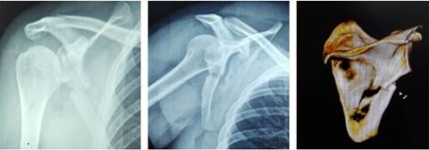 Manejo quirúrgico de fracturas extraarticulares de la escápula. Reporte ...