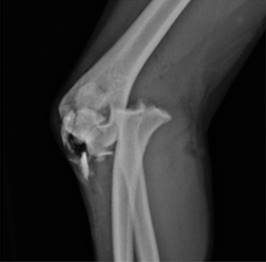 Fractura compleja de codo