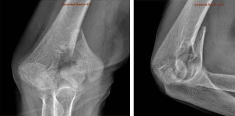 Fractura compleja de codo