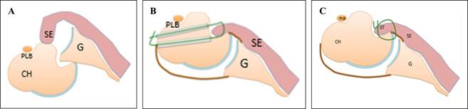 Luxación posterior inveterada de hombro asociada a lesión de Hill-Sachs ...