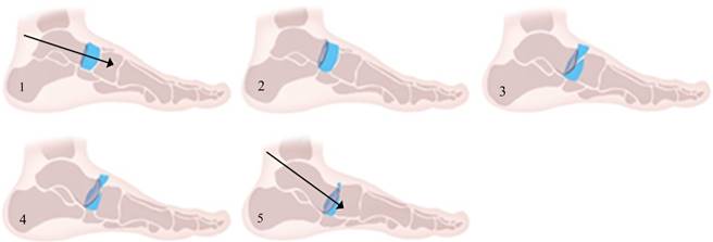 Tratamiento con soportes plantares en la enfermedad de Müller-Weiss ...