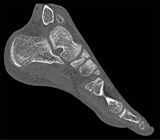 Tratamiento con soportes plantares en la enfermedad de Müller-Weiss ...