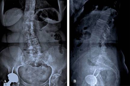 Incisional hernia, a rare complication of the anterolateral transpsoas ...