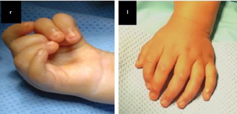Bilateral mirror hand: 2-year follow-up and literature review