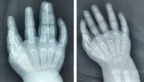 Bilateral mirror hand: 2-year follow-up and literature review