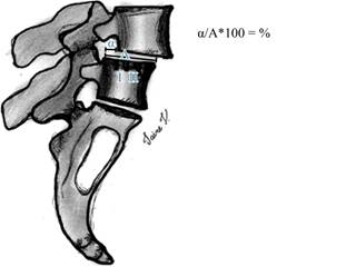 Degenerative spondylolisthesis I: general principles
