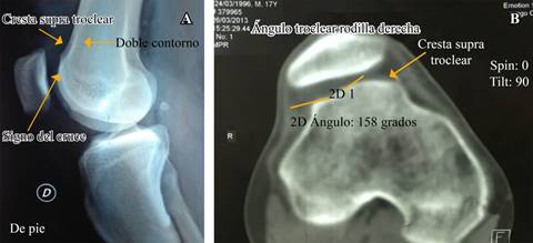 Tratamiento de la inestabilidad femoropatelar objetiva. Resultados a ...