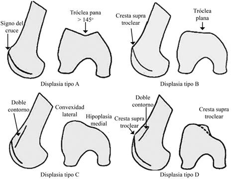 Tratamiento de la inestabilidad femoropatelar objetiva. Resultados a ...