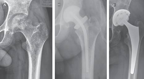 Arthroplasty as a treatment for acute and quiescent septic arthritis in ...