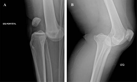 La lesión vascular asociada a la luxación de rodilla