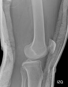 La lesión vascular asociada a la luxación de rodilla