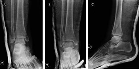 Seudoaneurisma de arteria peronea distal